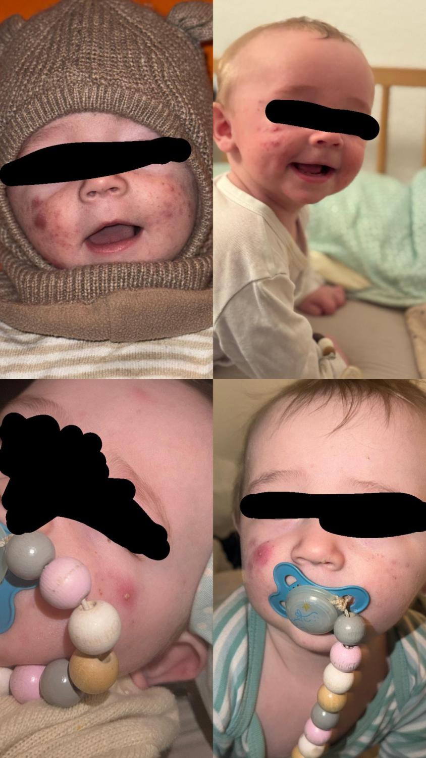 Baby 8 Monate alt seit Geburt Akne im Wagenbereich - Haut von Babys und ...